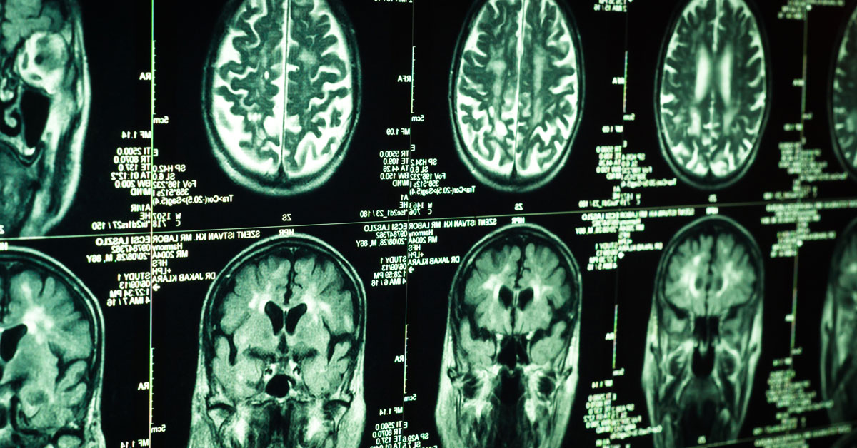 Traumatic Brain Injury Therapy, Cognitive Rehabilitation